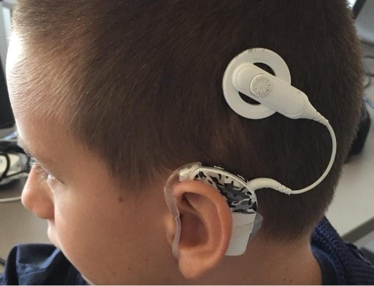 Implante Coclear
